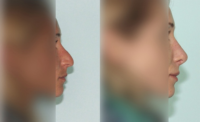 Rhinoplasty – Bariclinic